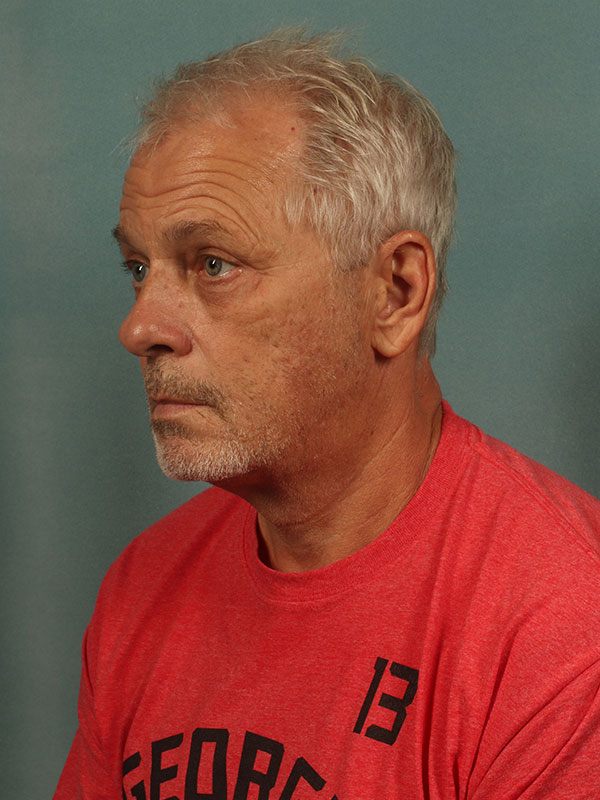 Before And After Blepharoplasty Athens Ga Avenue Aesthetic And Reconstructive Surgery