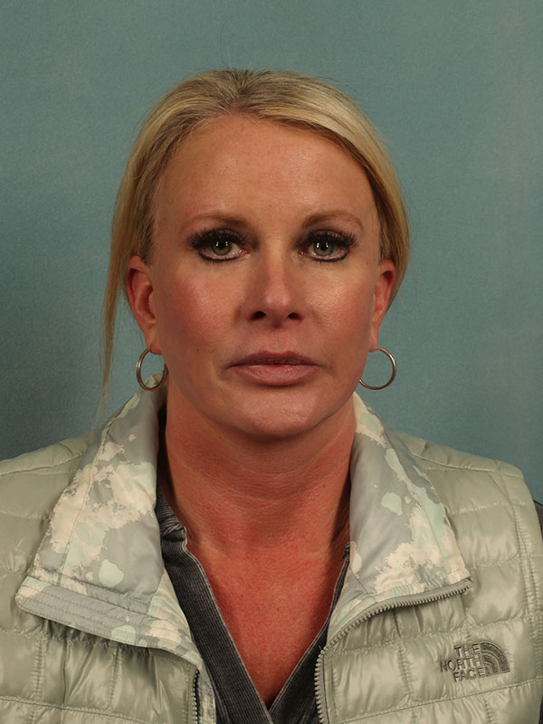 Before and After Brow Lift - Athens, GA - Avenue Aesthetic and ...