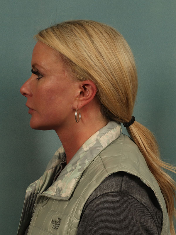 Before and After Brow Lift - Athens, GA - Avenue Aesthetic and ...