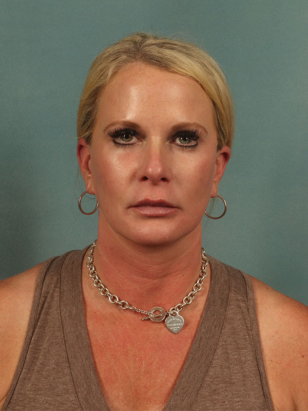 Before and After Brow Lift - Athens, GA - Avenue Aesthetic and ...