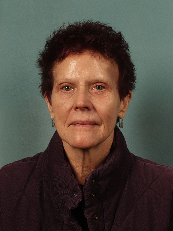 Before and After Brow Lift - Athens, GA - Avenue Aesthetic and ...