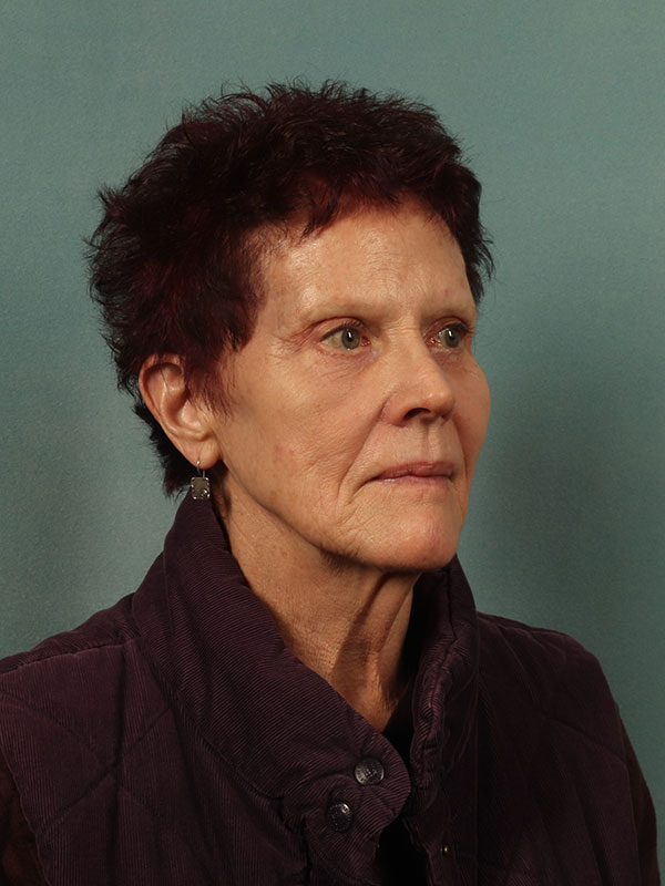 Before and After Brow Lift - Athens, GA - Avenue Aesthetic and ...