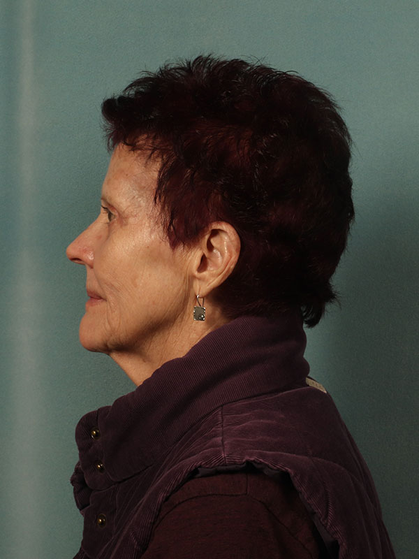 Before and After Brow Lift - Athens, GA - Avenue Aesthetic and ...