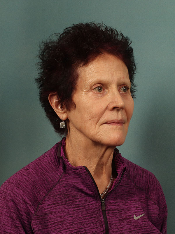 Before and After Brow Lift - Athens, GA - Avenue Aesthetic and ...