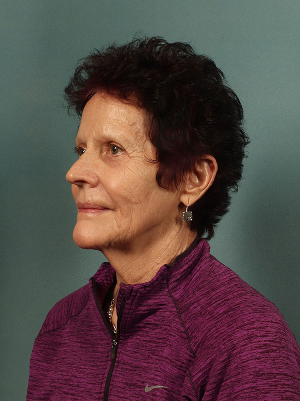 Before and After Brow Lift - Athens, GA - Avenue Aesthetic and ...