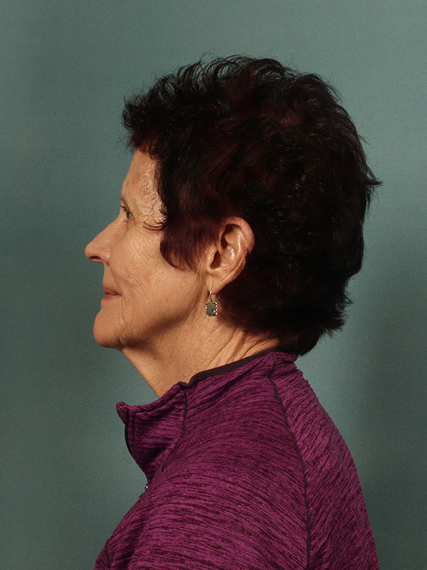 Before and After Brow Lift - Athens, GA - Avenue Aesthetic and ...