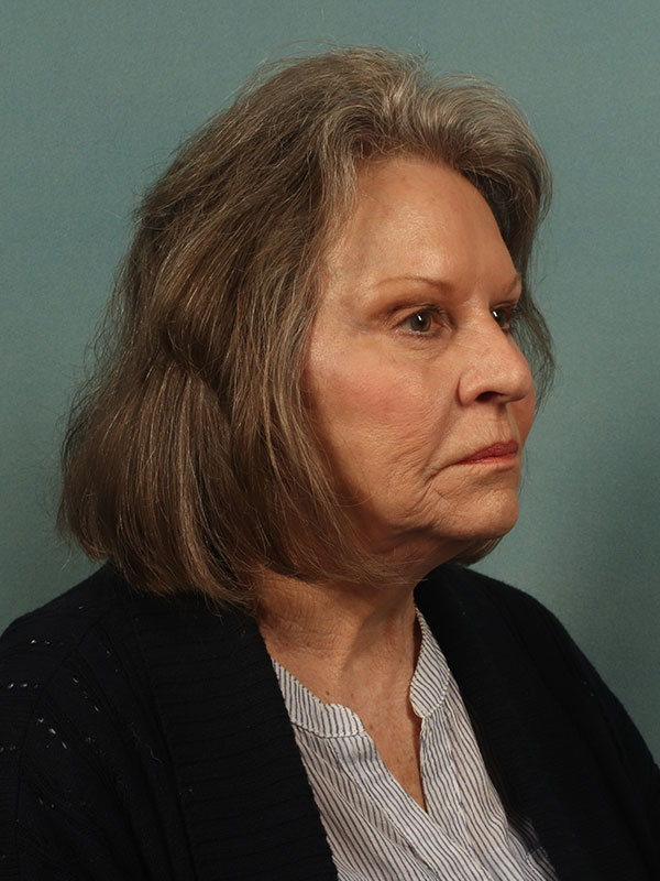 Before and After Brow Lift - Athens, GA - Avenue Aesthetic and ...