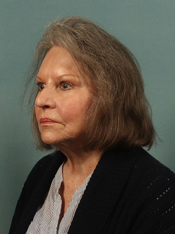 Before and After Brow Lift - Athens, GA - Avenue Aesthetic and ...