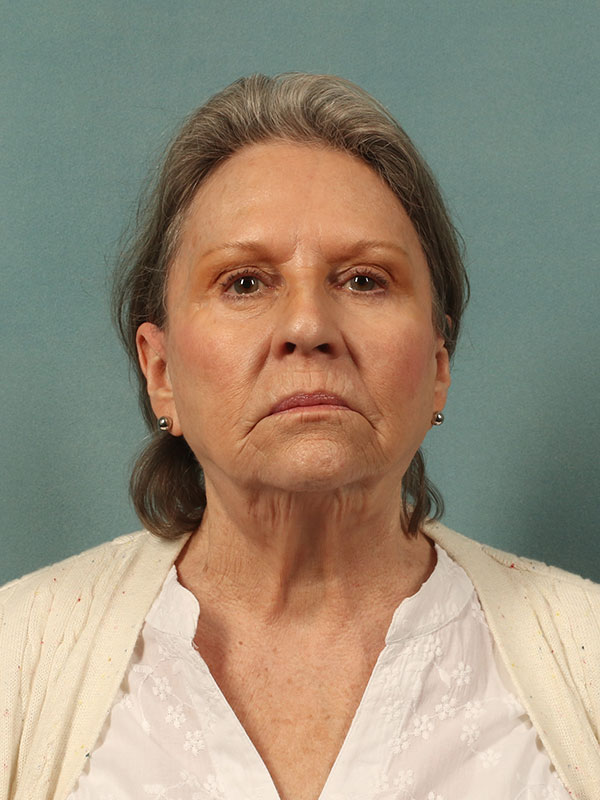 Before and After Brow Lift - Athens, GA - Avenue Aesthetic and ...