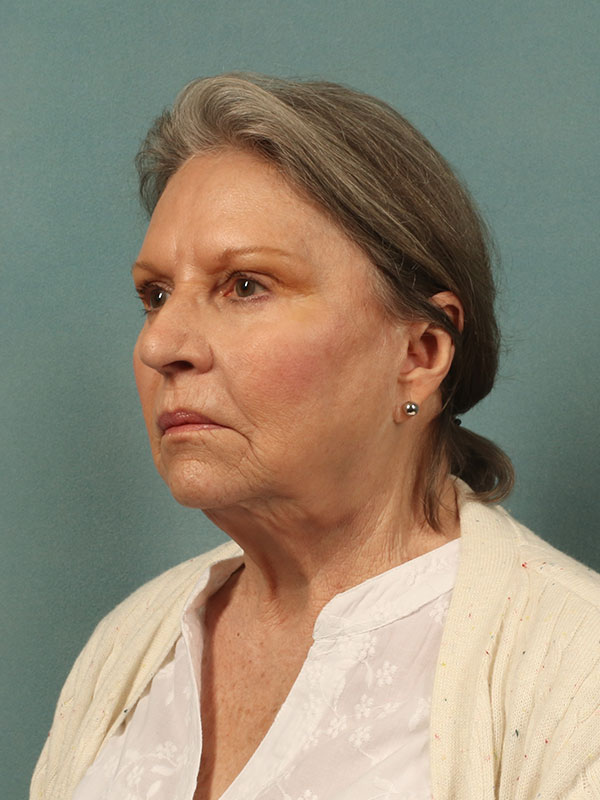 Before and After Brow Lift - Athens, GA - Avenue Aesthetic and ...